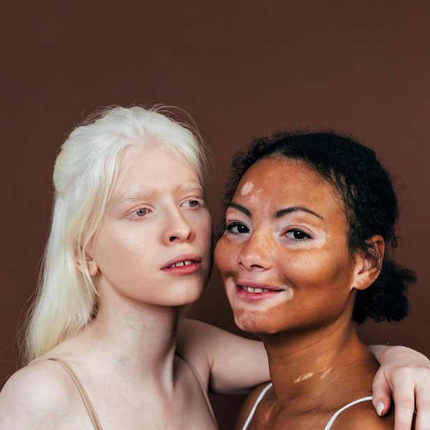 Get Quick & Accurate Results with Albinism scan at Lucid Diagnostics